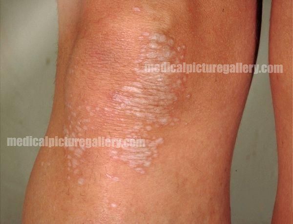 Lichen sclerosus et atrophicus